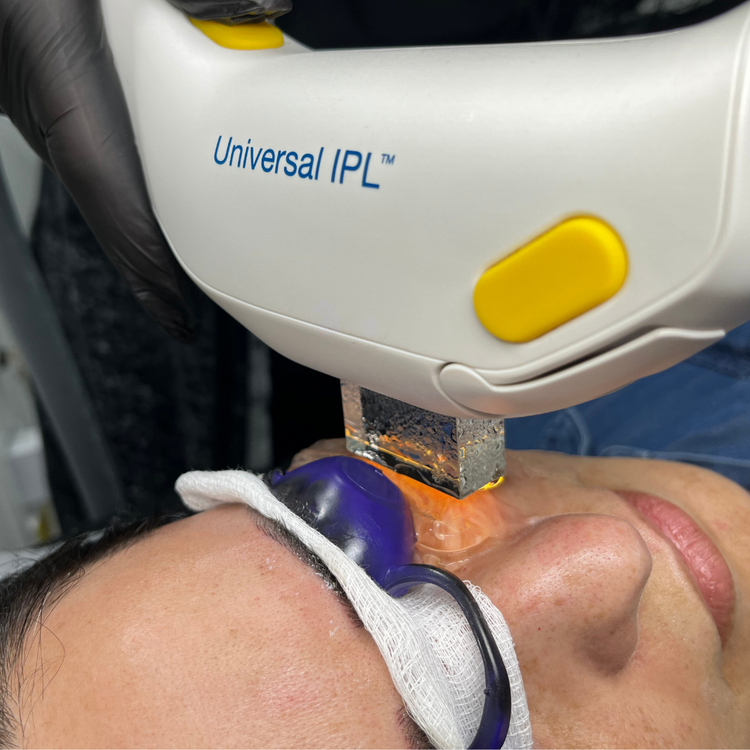 Achieve Flawless Skin with IPL - Intense Pulse Light Treatment