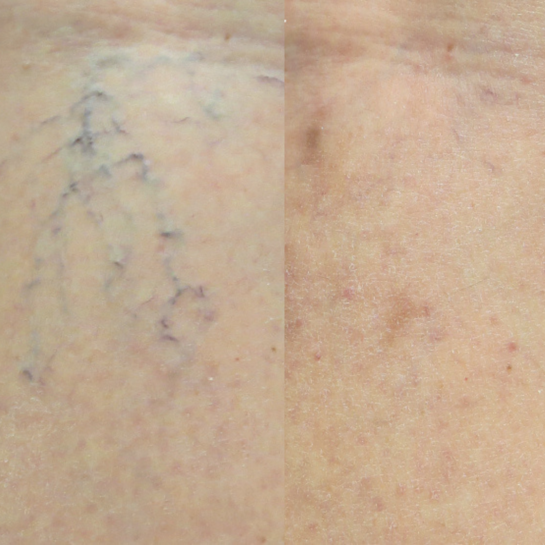 ND: YAG Veins/Angiomas | Encanta Cejas