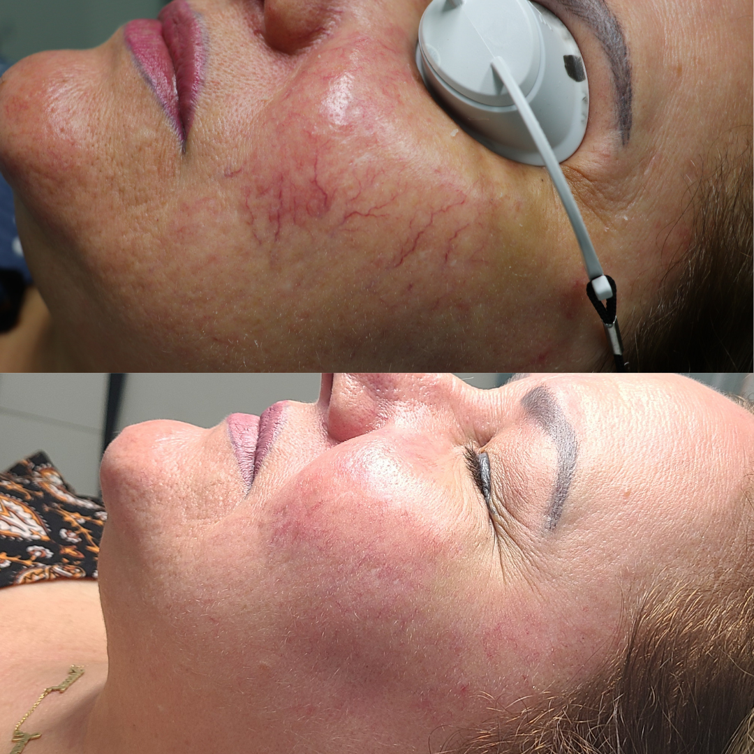Nd:Yag Telengactacias | Encanta Cejas