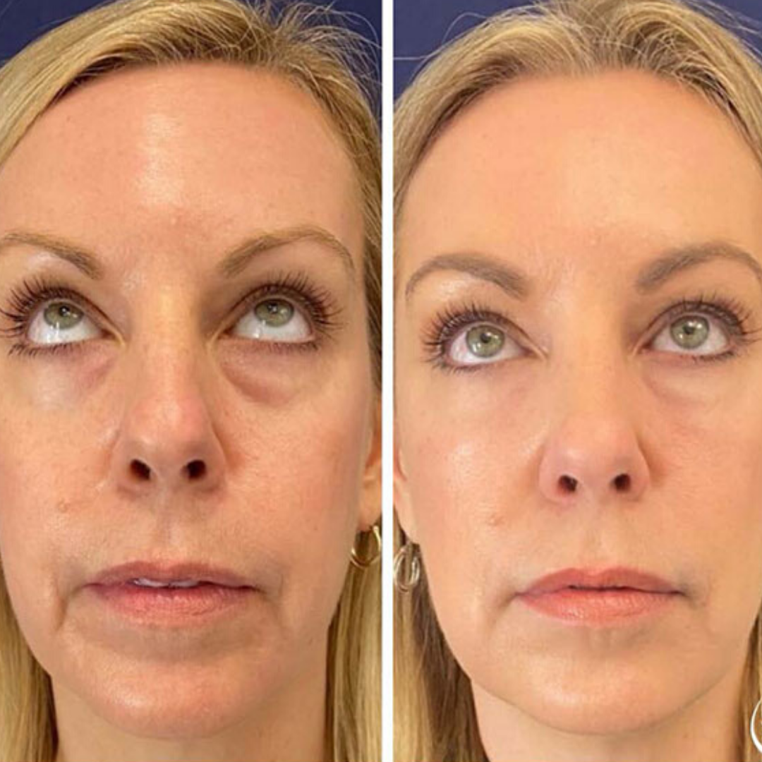 PRF Regenerative | Encanta Cejas